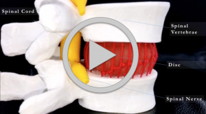 Slip Disc Treatment Singapore | Disc Replacement – SG Doctor